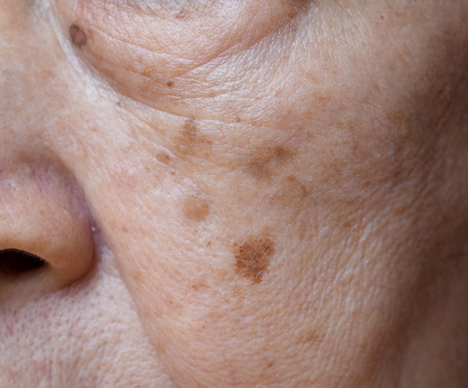 Pigmentation & PIH: Advice & Management – AESTHETICARE
