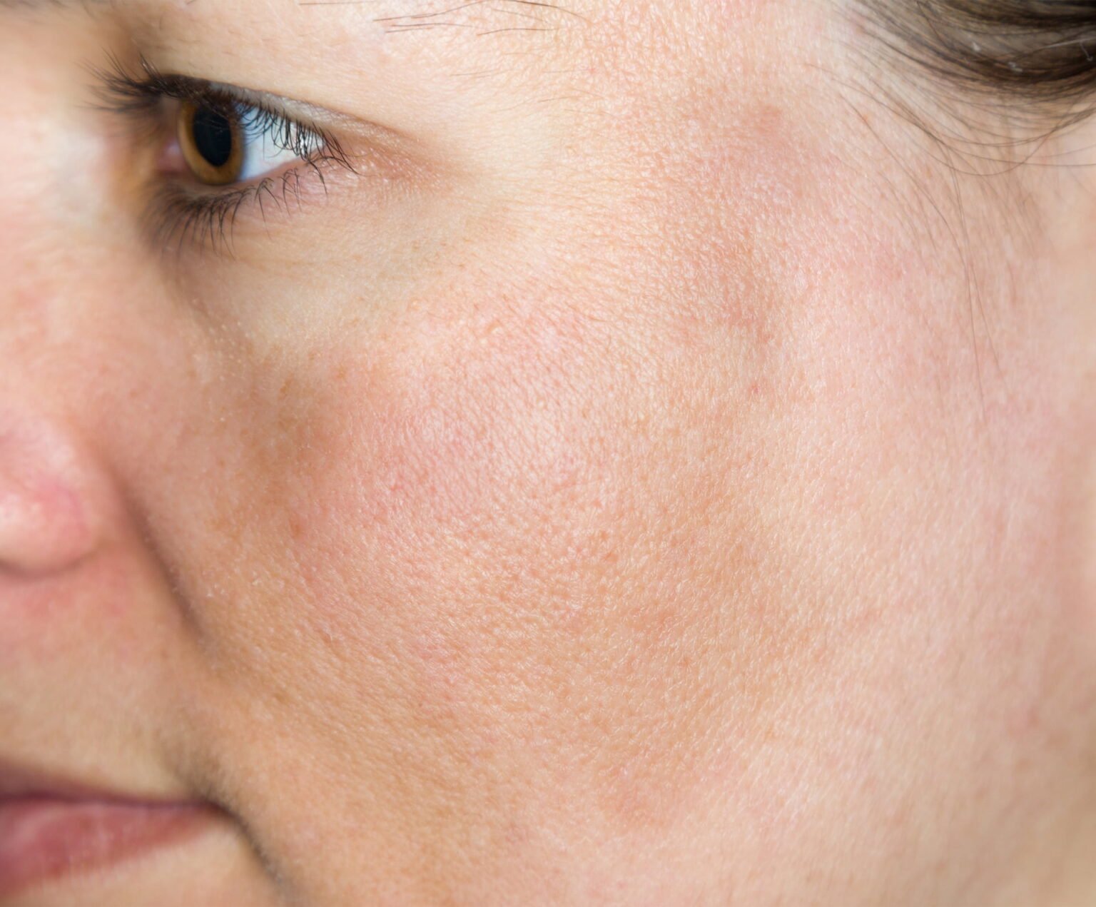 Pigmentation & PIH: Advice & Management – AESTHETICARE